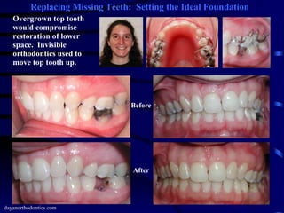 Restoring Missing Teeth & Collapsed Bite | PPT