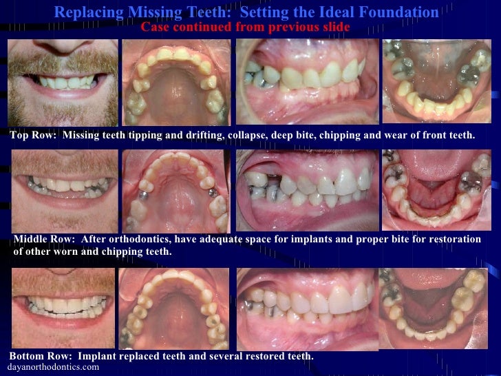 Restoring Missing Teeth & Collapsed Bite