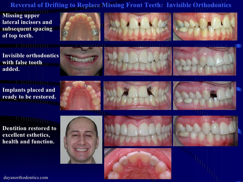 Restoring Missing Teeth & Collapsed Bite