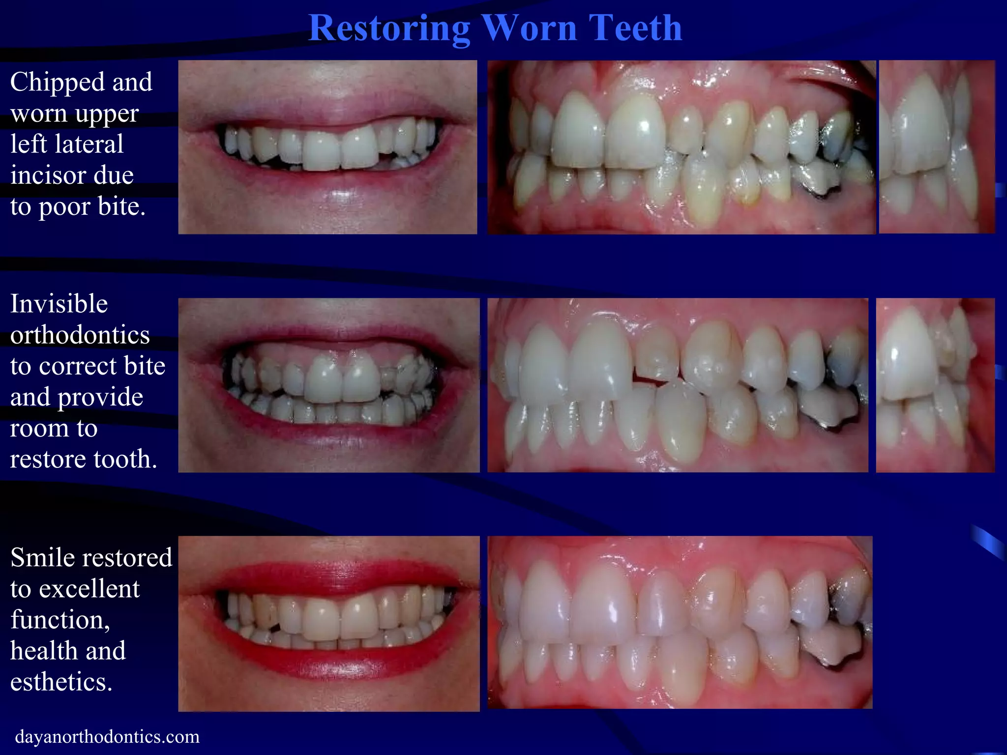 Restoring Worn, Chipped & Broken Teeth | PPT