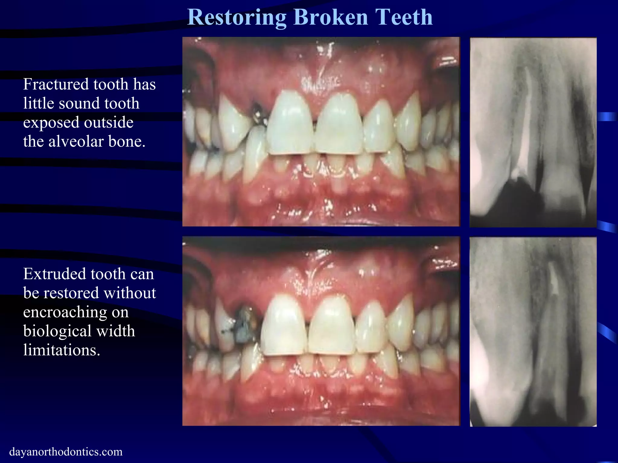 Restoring Worn, Chipped & Broken Teeth | PPT