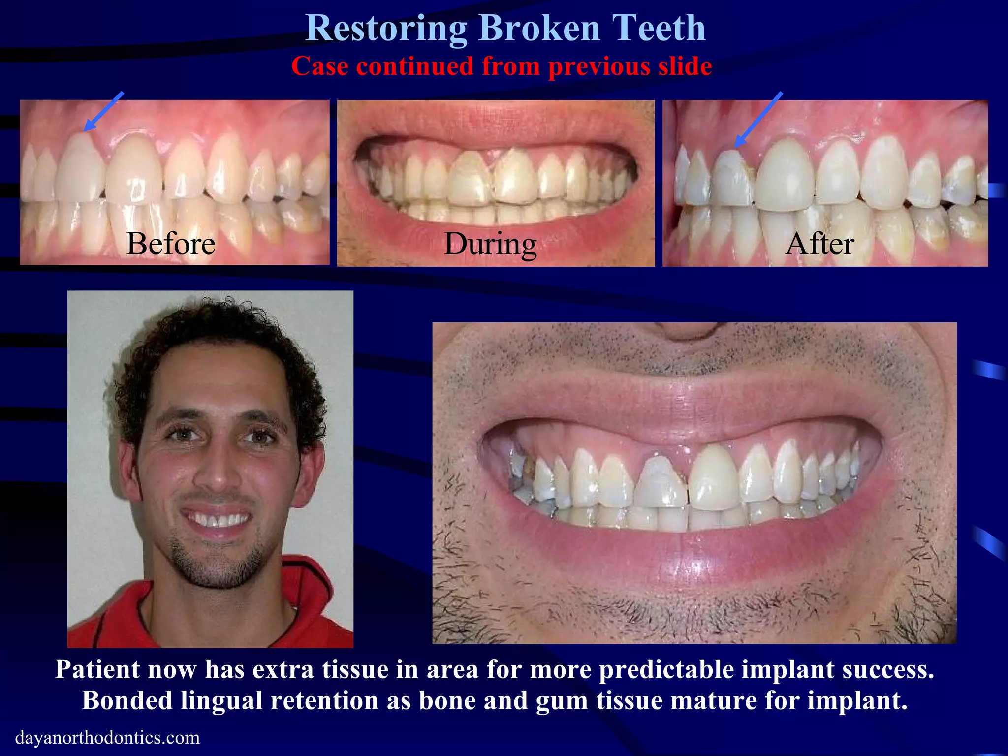 Restoring Worn, Chipped & Broken Teeth | PPT