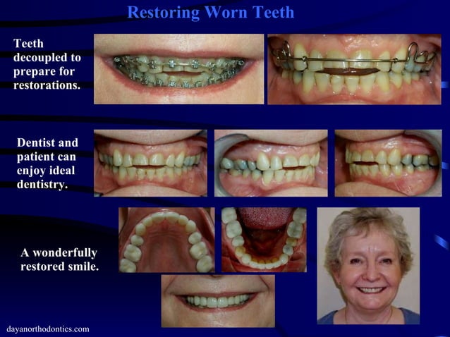 Restoring Worn, Chipped & Broken Teeth | PPT