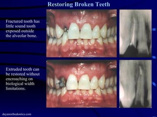 Restoring Worn, Chipped & Broken Teeth | PPT