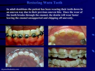 Restoring Worn, Chipped & Broken Teeth | PPT