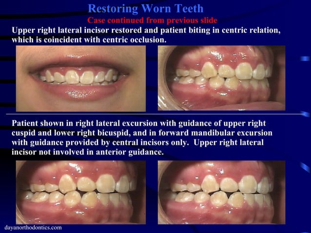 Restoring Worn, Chipped & Broken Teeth | PPT