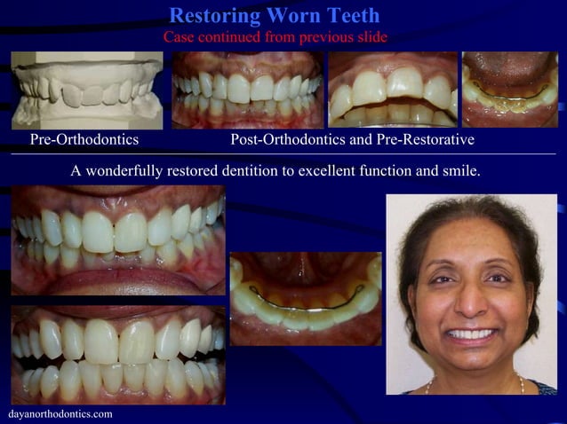 Restoring Worn, Chipped & Broken Teeth | PPT