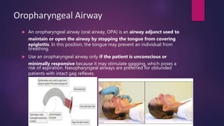 Restoring airway patency | PPTX