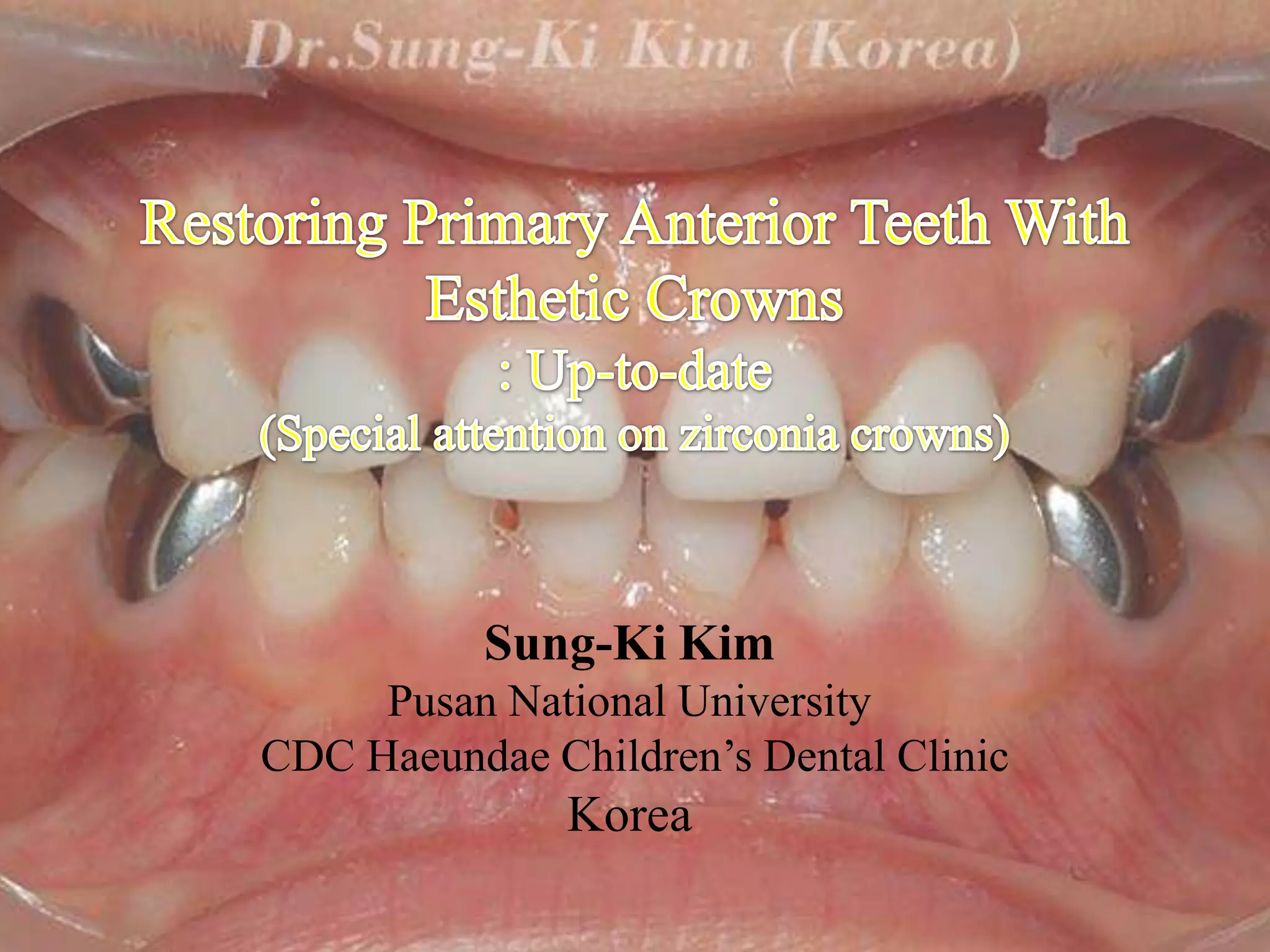 Restoring primary anterior teeth with esthetic crowns | PPTX