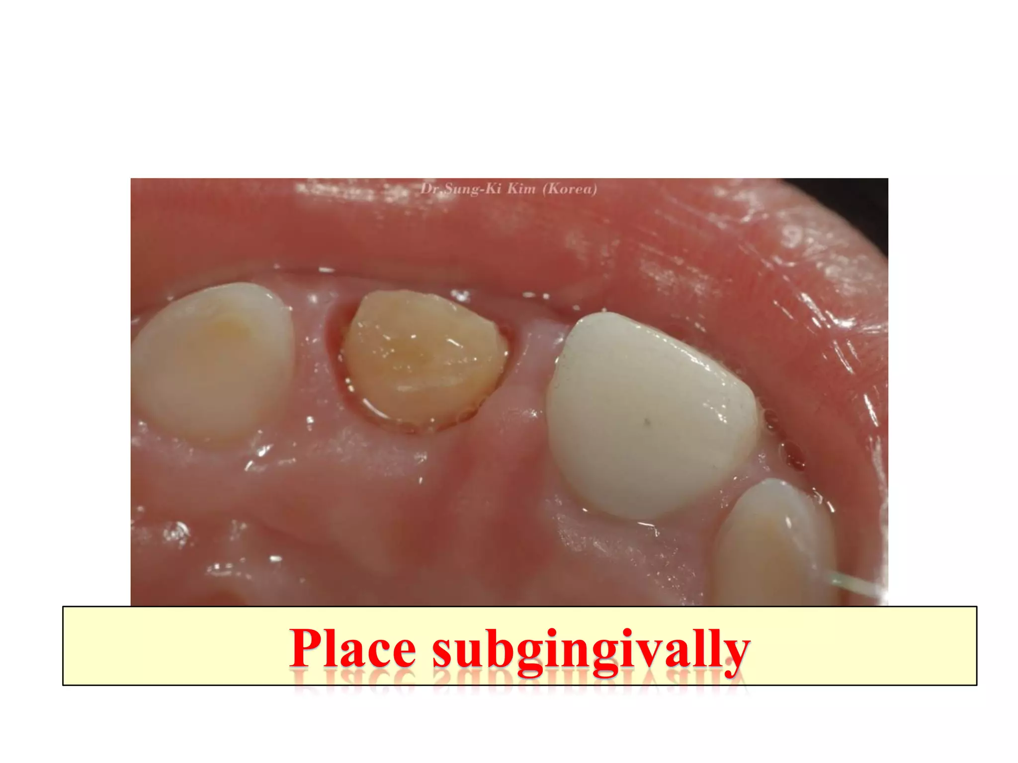 Restoring primary anterior teeth with esthetic crowns | PPTX