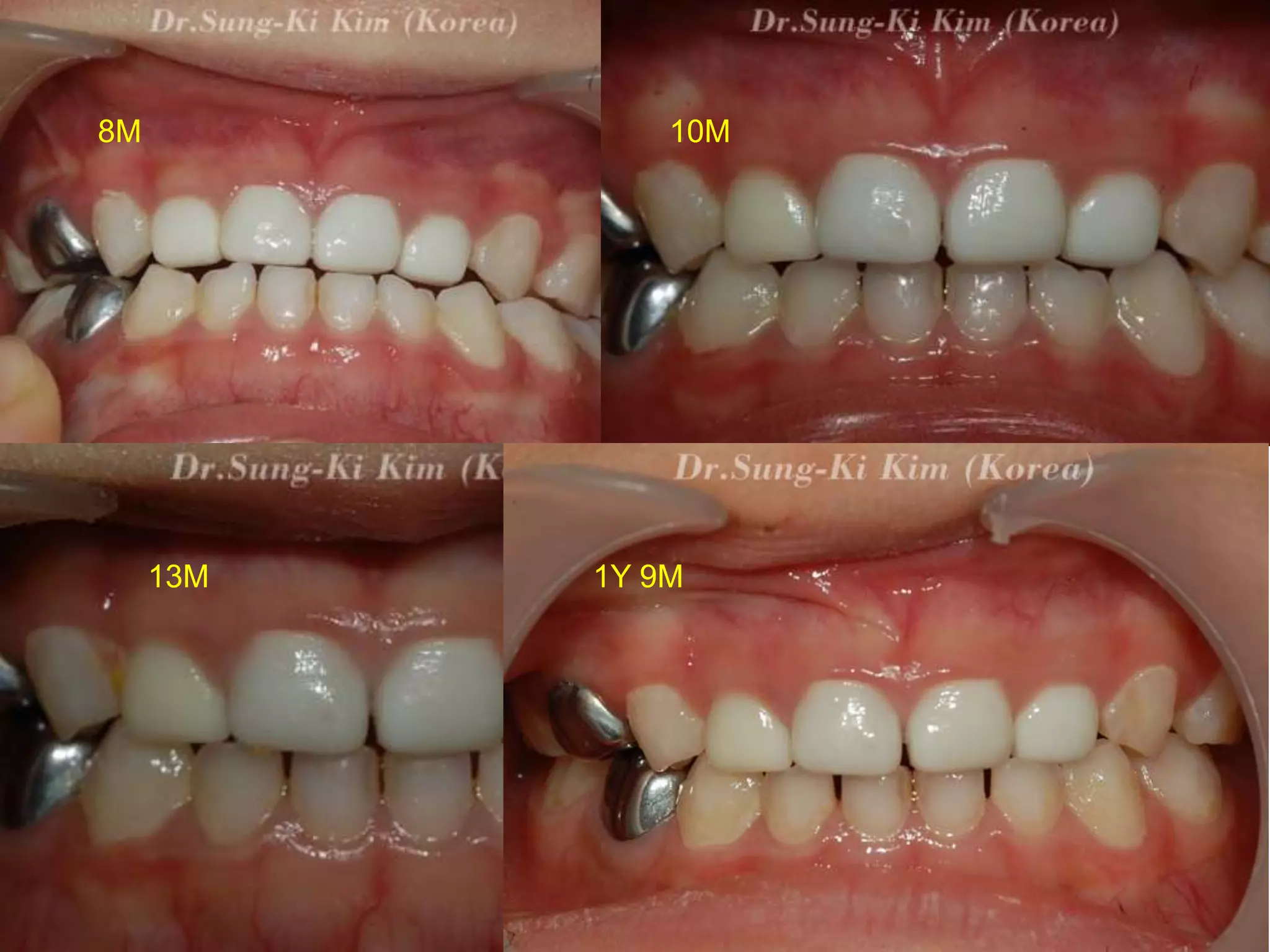Restoring primary anterior teeth with esthetic crowns | PPTX