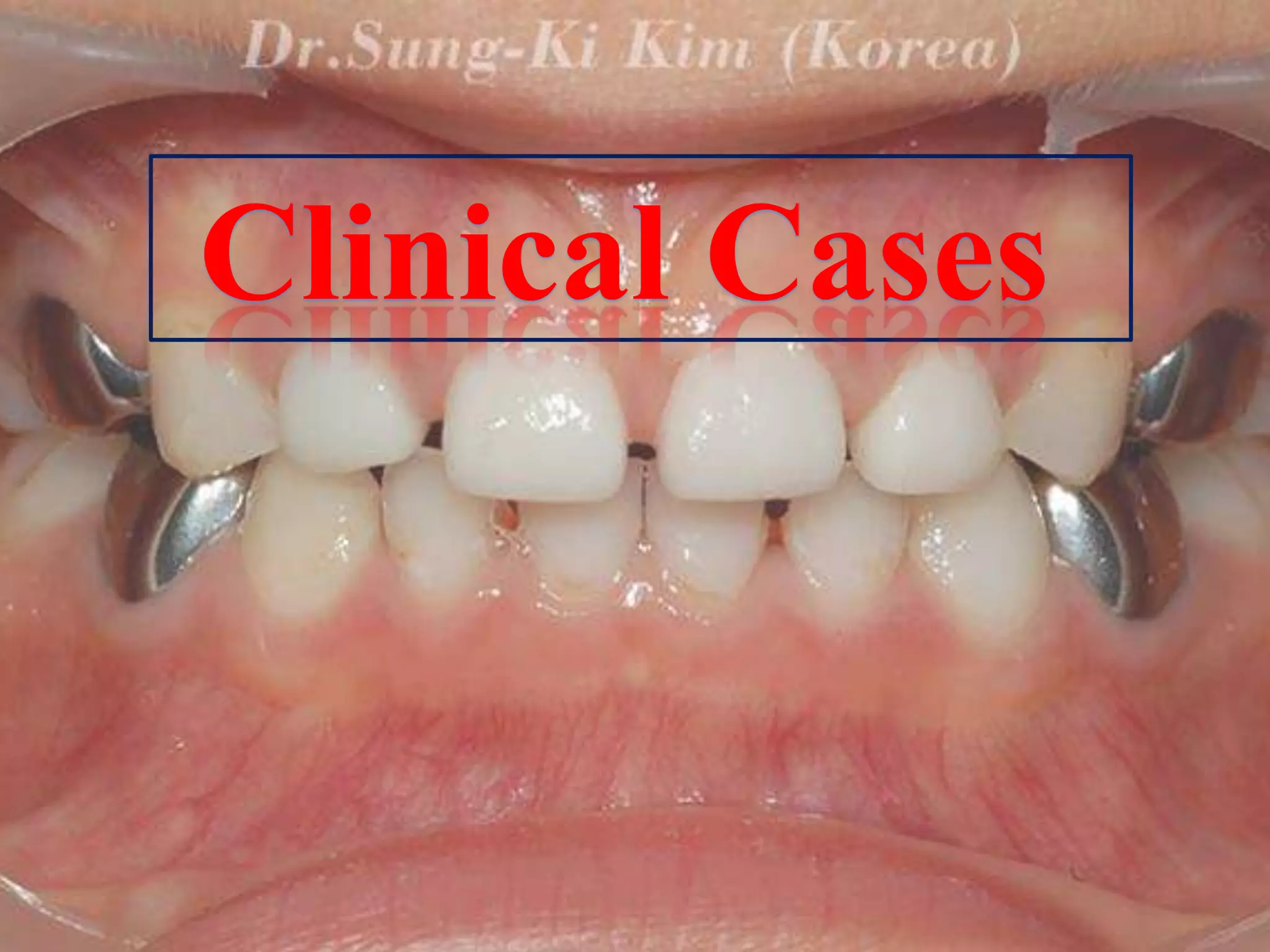 Restoring primary anterior teeth with esthetic crowns | PPTX