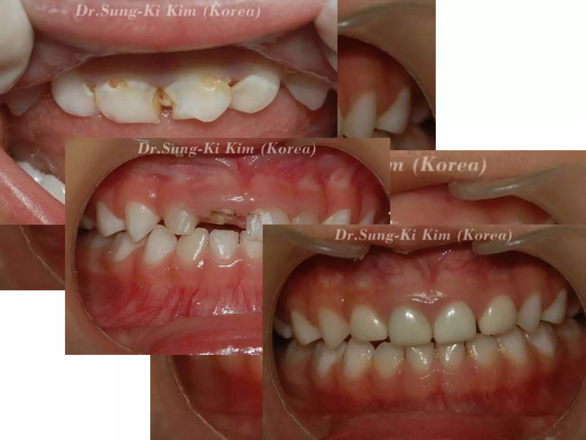 Restoring primary anterior teeth with esthetic crowns | PPTX