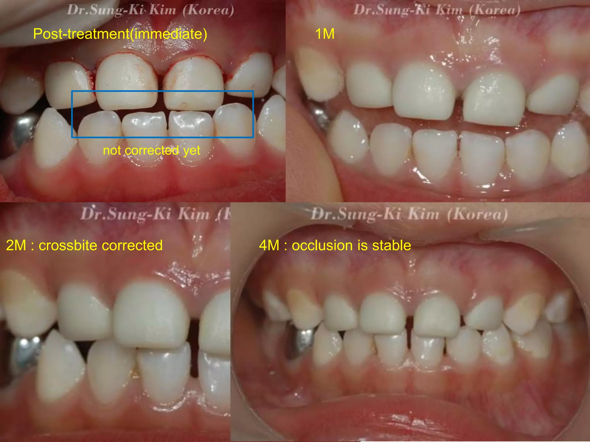 Restoring primary anterior teeth with esthetic crowns | PPT