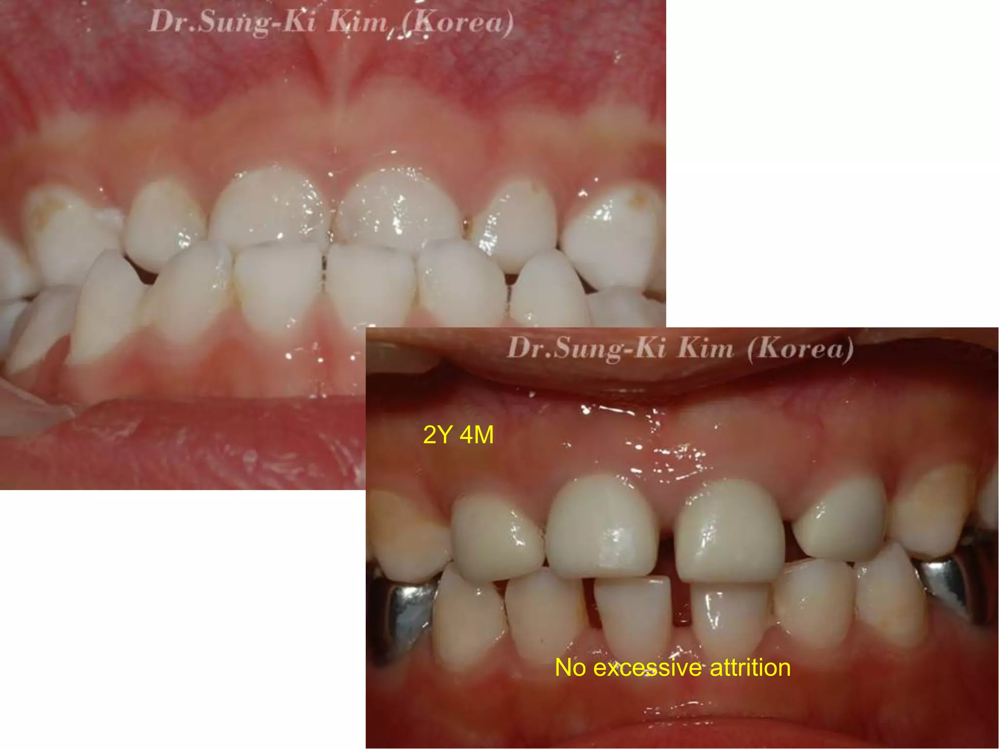 Restoring primary anterior teeth with esthetic crowns | PPTX