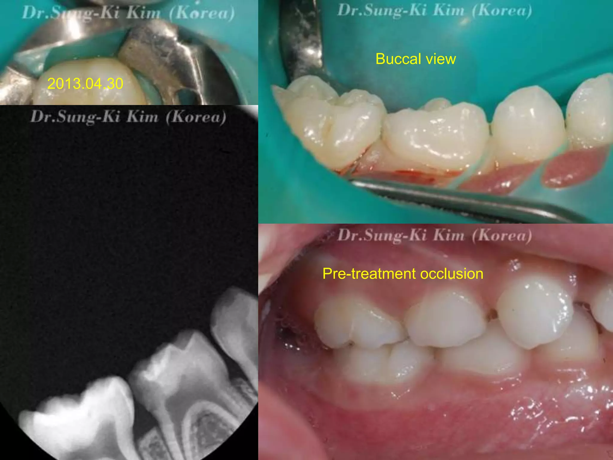 Restoring primary anterior teeth with esthetic crowns | PPTX
