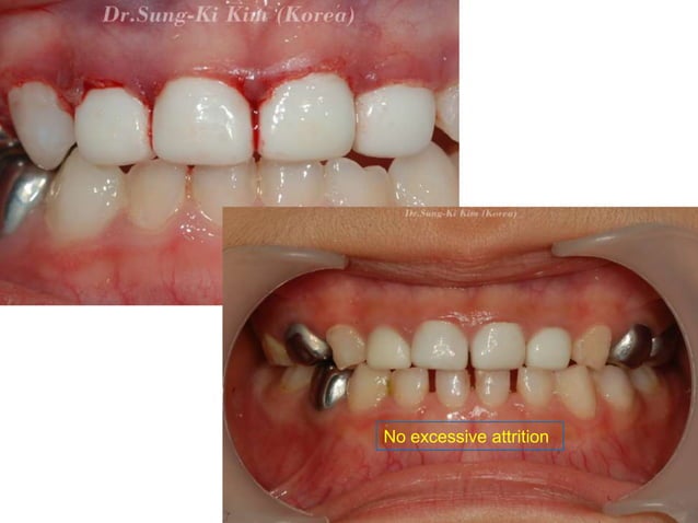 Restoring primary anterior teeth with esthetic crowns | PPTX | Dental ...