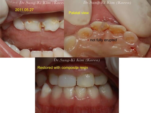 Restoring primary anterior teeth with esthetic crowns | PPTX | Dental ...