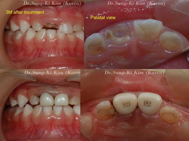 Restoring primary anterior teeth with esthetic crowns | PPTX | Dental ...