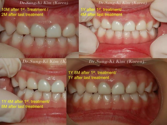 Restoring primary anterior teeth with esthetic crowns | PPTX | Dental ...