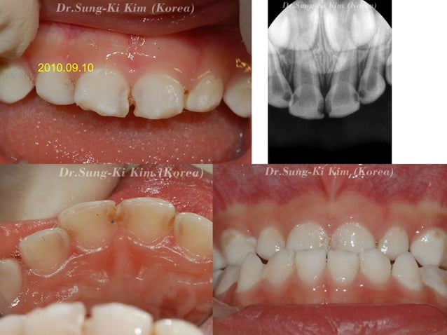 Restoring primary anterior teeth with esthetic crowns | PPT
