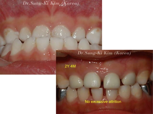 Restoring primary anterior teeth with esthetic crowns | PPTX | Dental ...