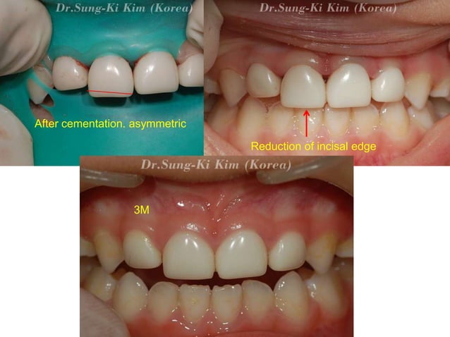Restoring primary anterior teeth with esthetic crowns | PPTX | Dental ...
