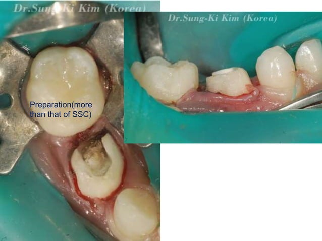 Restoring primary anterior teeth with esthetic crowns | PPTX | Dental ...