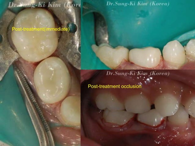 Restoring primary anterior teeth with esthetic crowns | PPTX | Dental ...