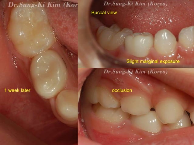 Restoring primary anterior teeth with esthetic crowns | PPTX | Dental ...
