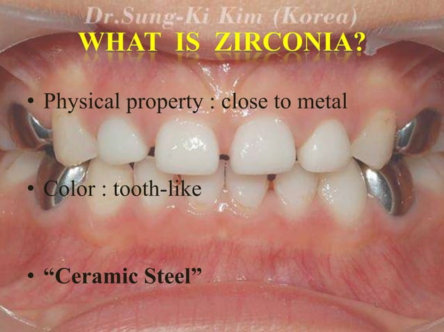 Restoring primary anterior teeth with esthetic crowns | PPTX | Dental ...
