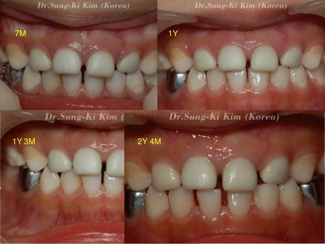 Restoring primary anterior teeth with esthetic crowns