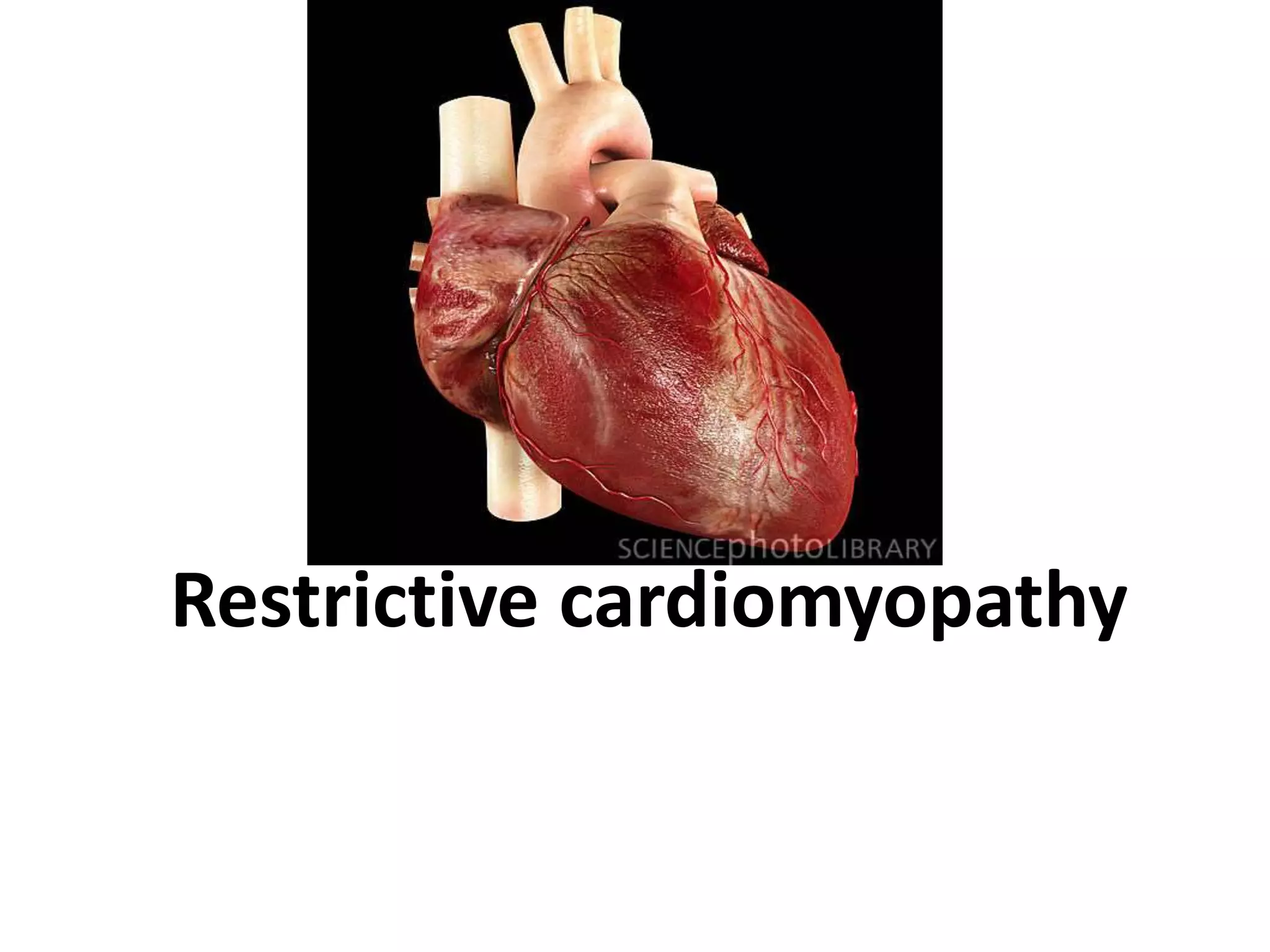 Restrictive cardiomyopathy | PPTX