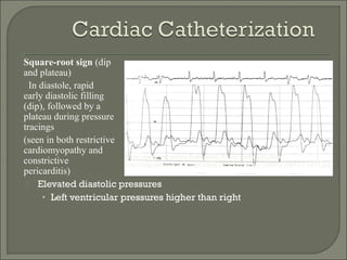 Constrictive Pericarditis Square Root Sign