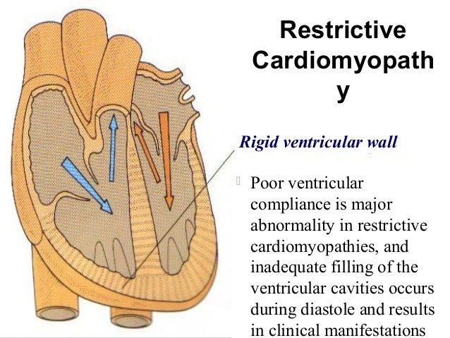Restrictive cardiomyopathy