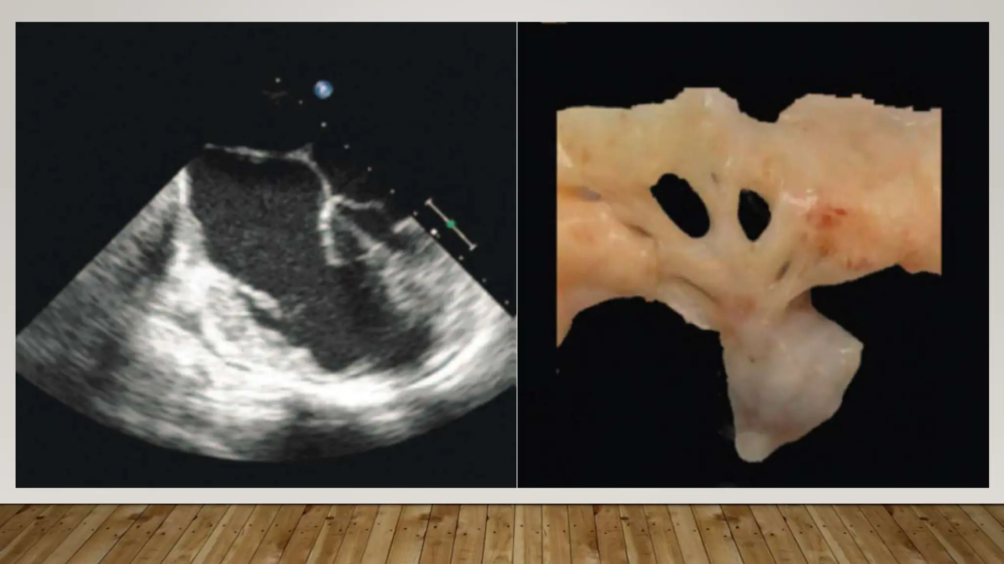 Restrictive cardiomyopathy-VALSALVA, KUSSUMAL ITS IMPORTANCE IN DDpptx ...