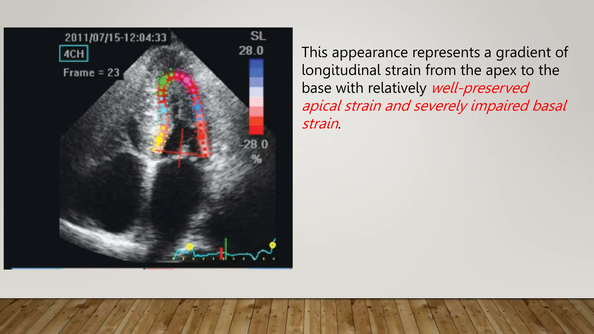 Restrictive cardiomyopathy-VALSALVA, KUSSUMAL ITS IMPORTANCE IN DDpptx ...
