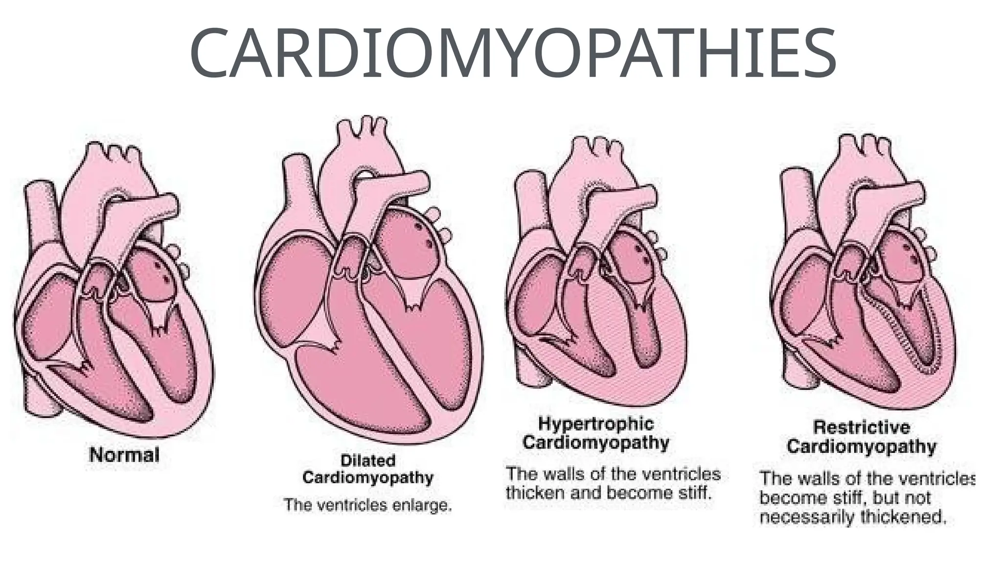 Restrictive cardiomyopathy-definition, pathogenesis.pptx