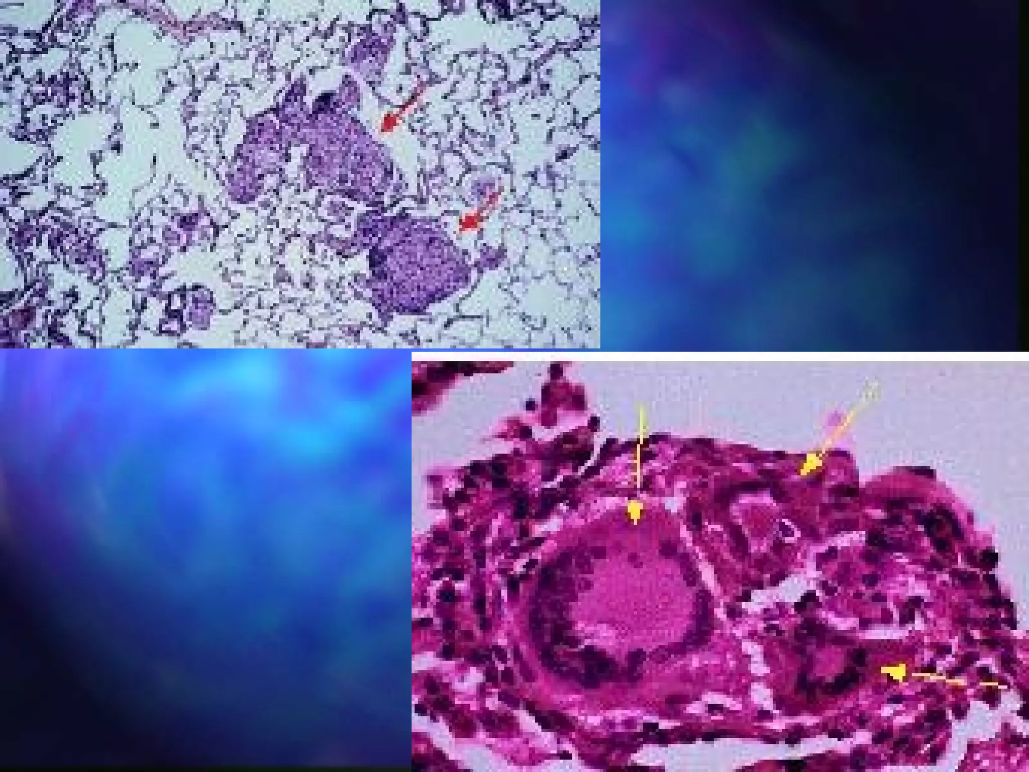 Restrictive lung disease | PPT