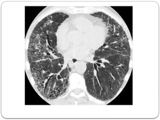 RESTRICTIVE LUNG DISEASE AND ITS PHYSIOTHERAPY ASSESSMENT AND ...