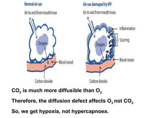 4 Restrictive Lung Diseases | PPT