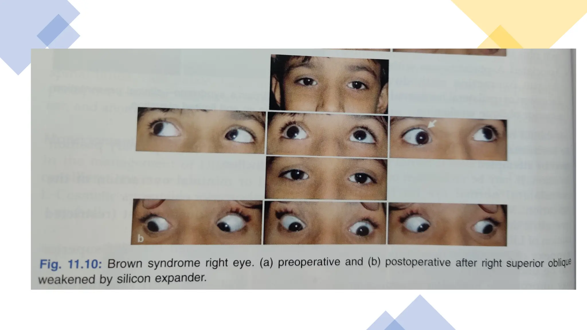 RESTRICTIVE STRABISMUS-1 in ophthalmology- (1).pptx