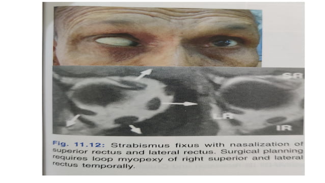 RESTRICTIVE STRABISMUS-1 in ophthalmology- (1).pptx
