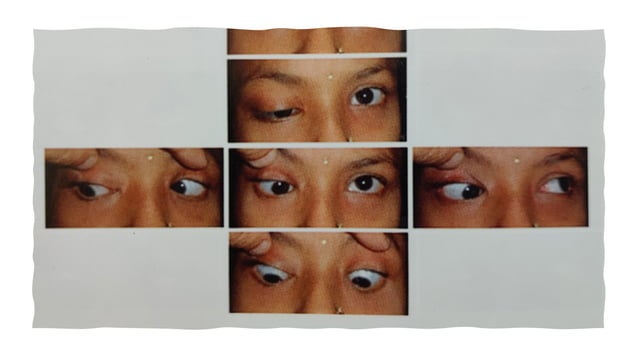 RESTRICTIVE STRABISMUS-1 in ophthalmology- (1).pptx