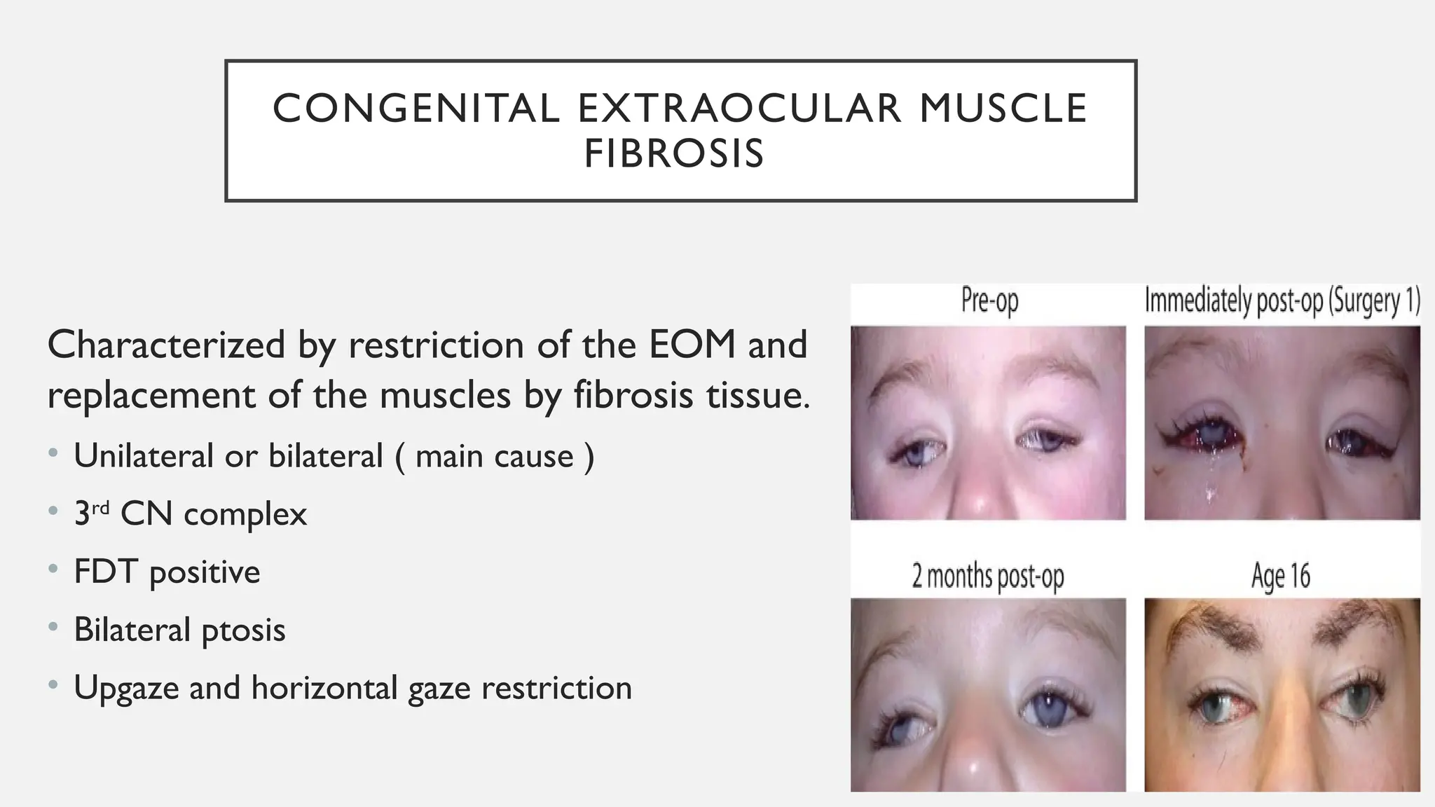 RESTRICTIVE STRABISMUS BY ASRA WAREES.pptx