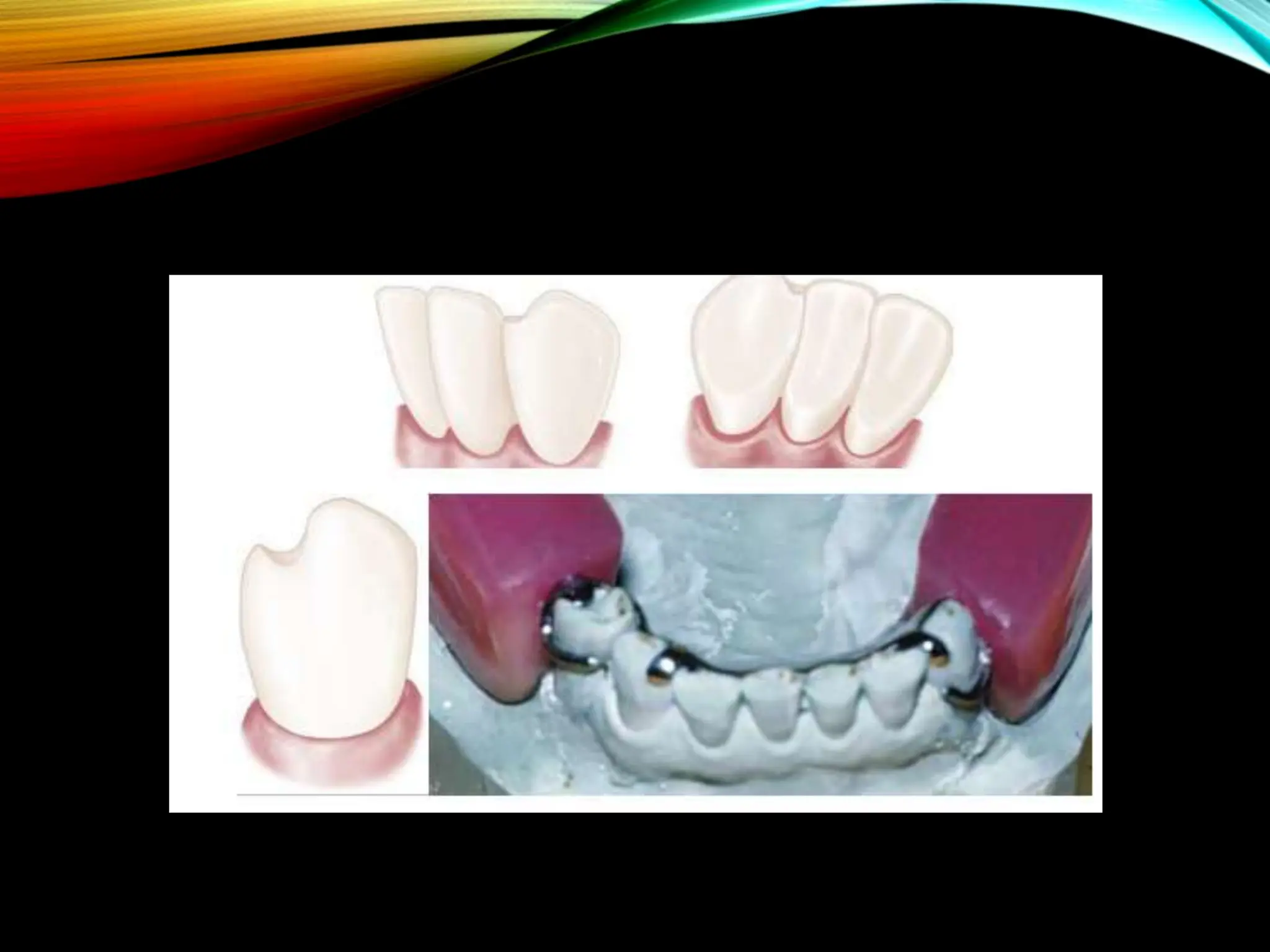 Rests and Rest Seats- prosthodontics. Autosaved pptx | PPTX
