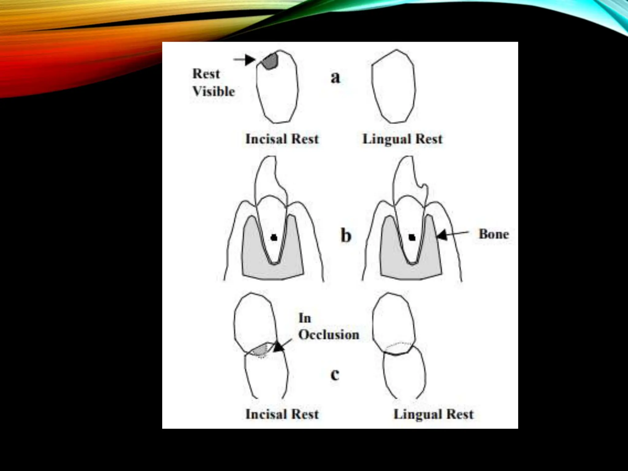 Rests and Rest Seats- prosthodontics. Autosaved pptx | PPTX