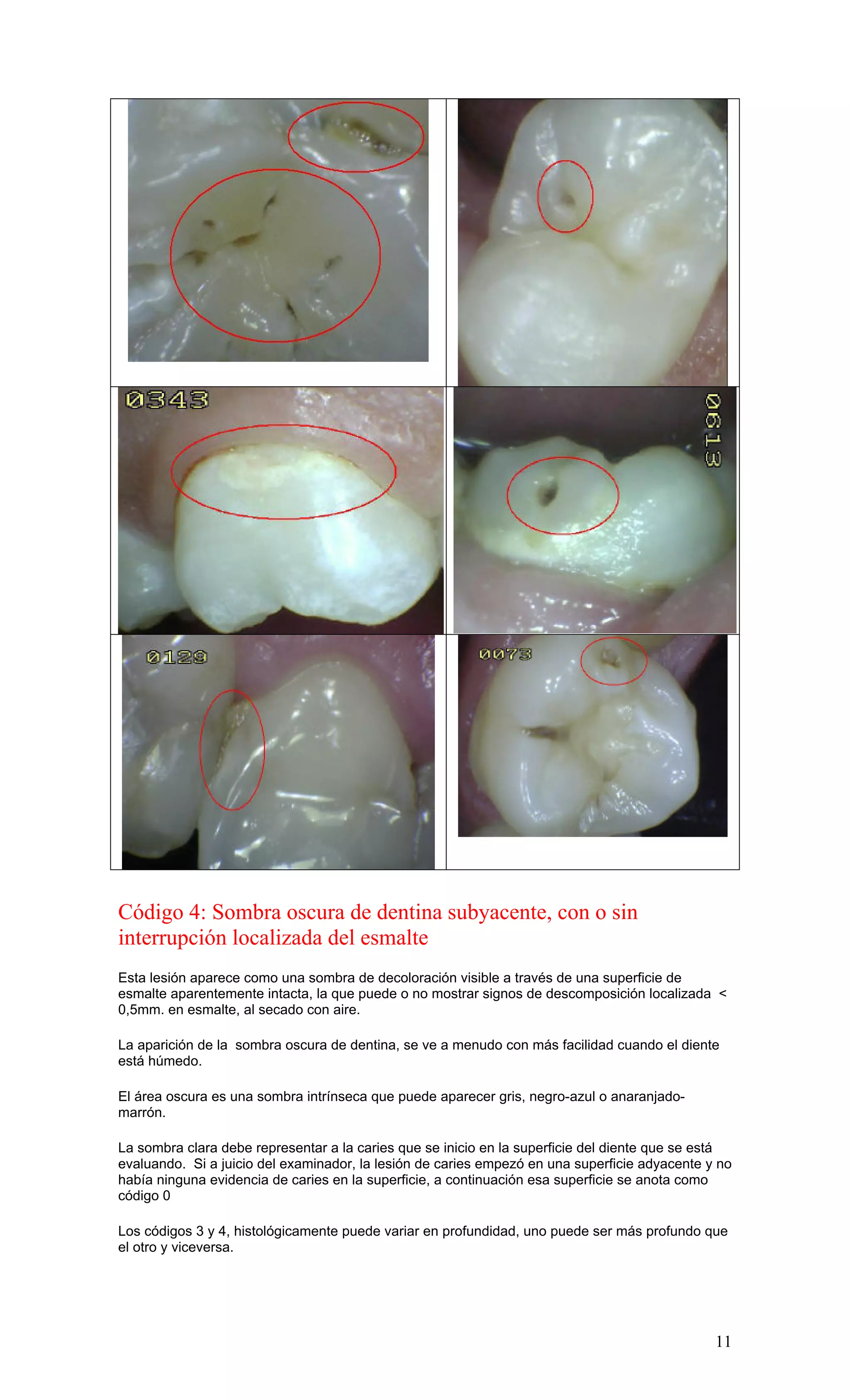 Resumen diagnostico-de-icdas | PDF | Oral care | Personal Care