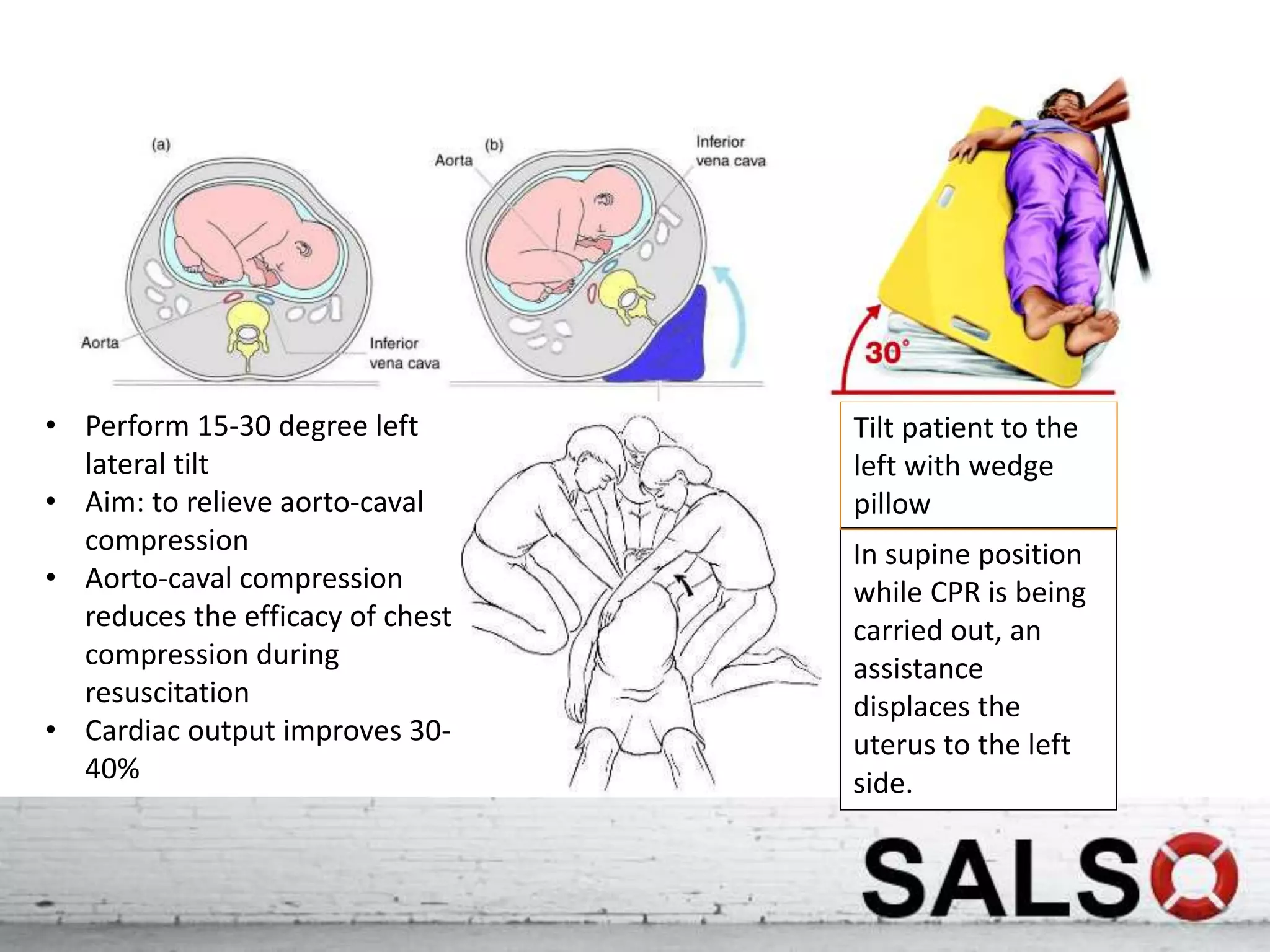 Maternal Resuscitation 2018 | PPTX