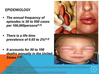Resuscitation techniques in anaphylaxis | PPTX